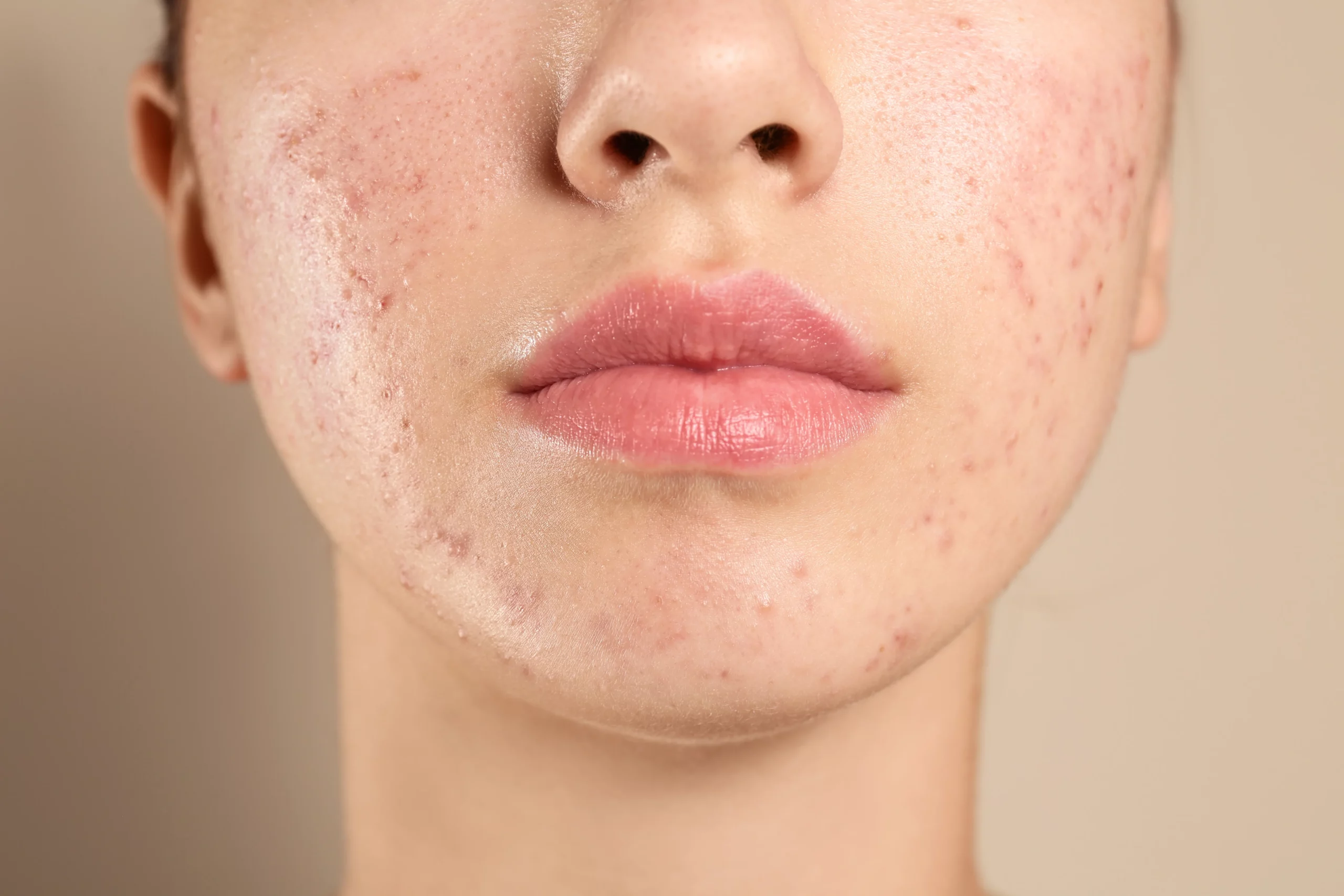 Fotona Laser Acne Treatment – Renovo Medispa